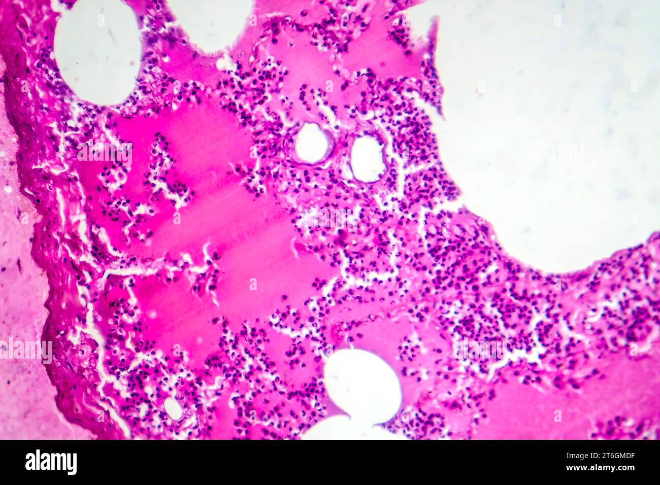 Photomicrograph of lobar pneumonia during the hemorrhagic edema period ...
