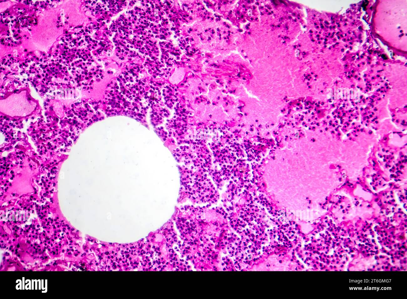 Photomicrograph of lobar pneumonia during the hemorrhagic edema period ...