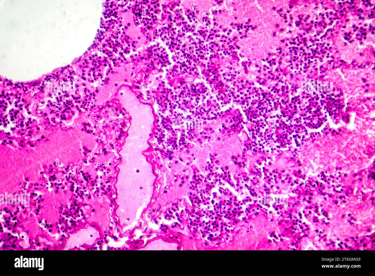 Photomicrograph of lobar pneumonia during the hemorrhagic edema period ...
