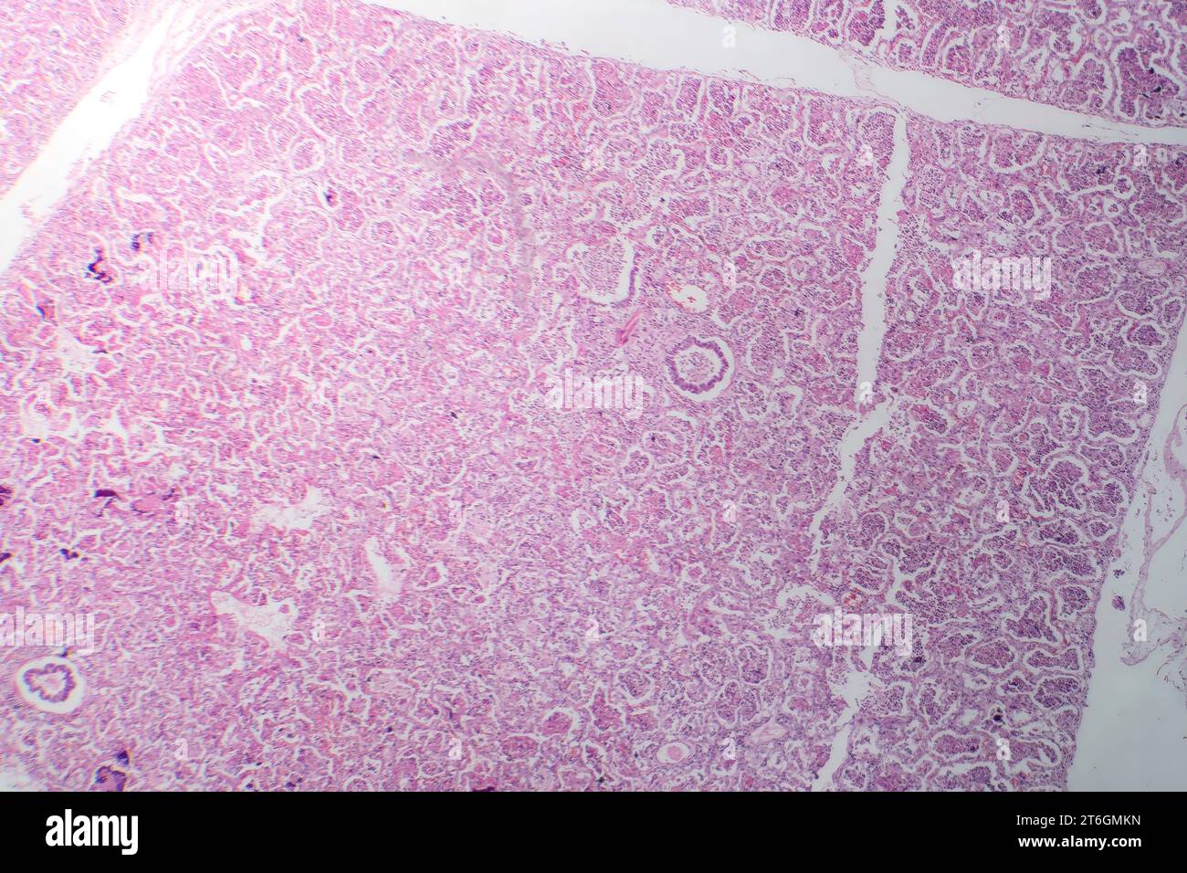 Photomicrograph of lobar pneumonia in red hepatic phase, displaying ...
