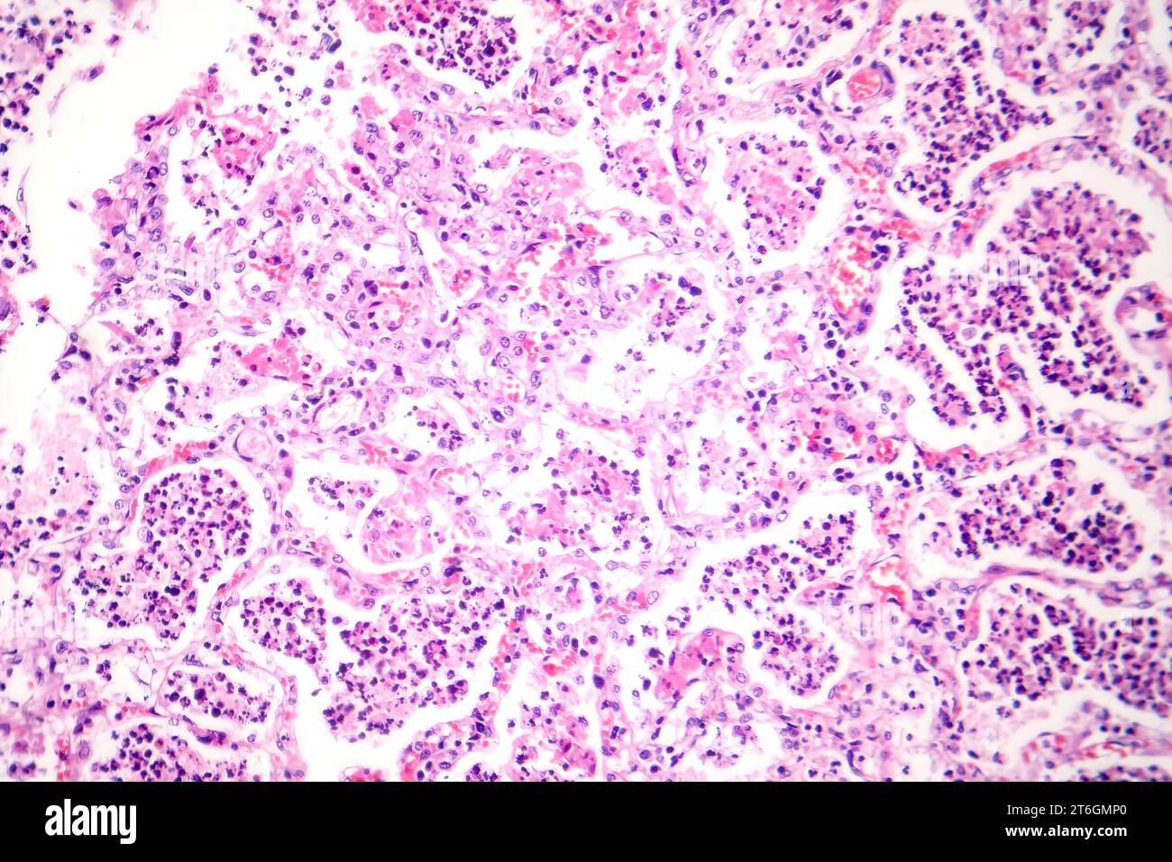 Photomicrograph of lobar pneumonia in red hepatic phase, displaying ...