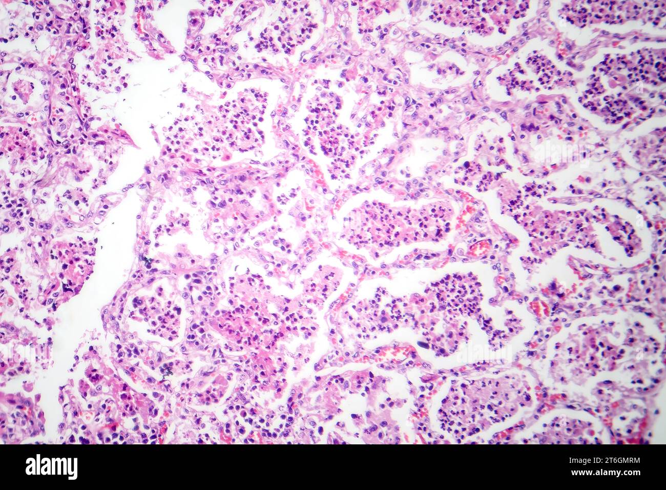 Photomicrograph of lobar pneumonia in red hepatic phase, displaying ...
