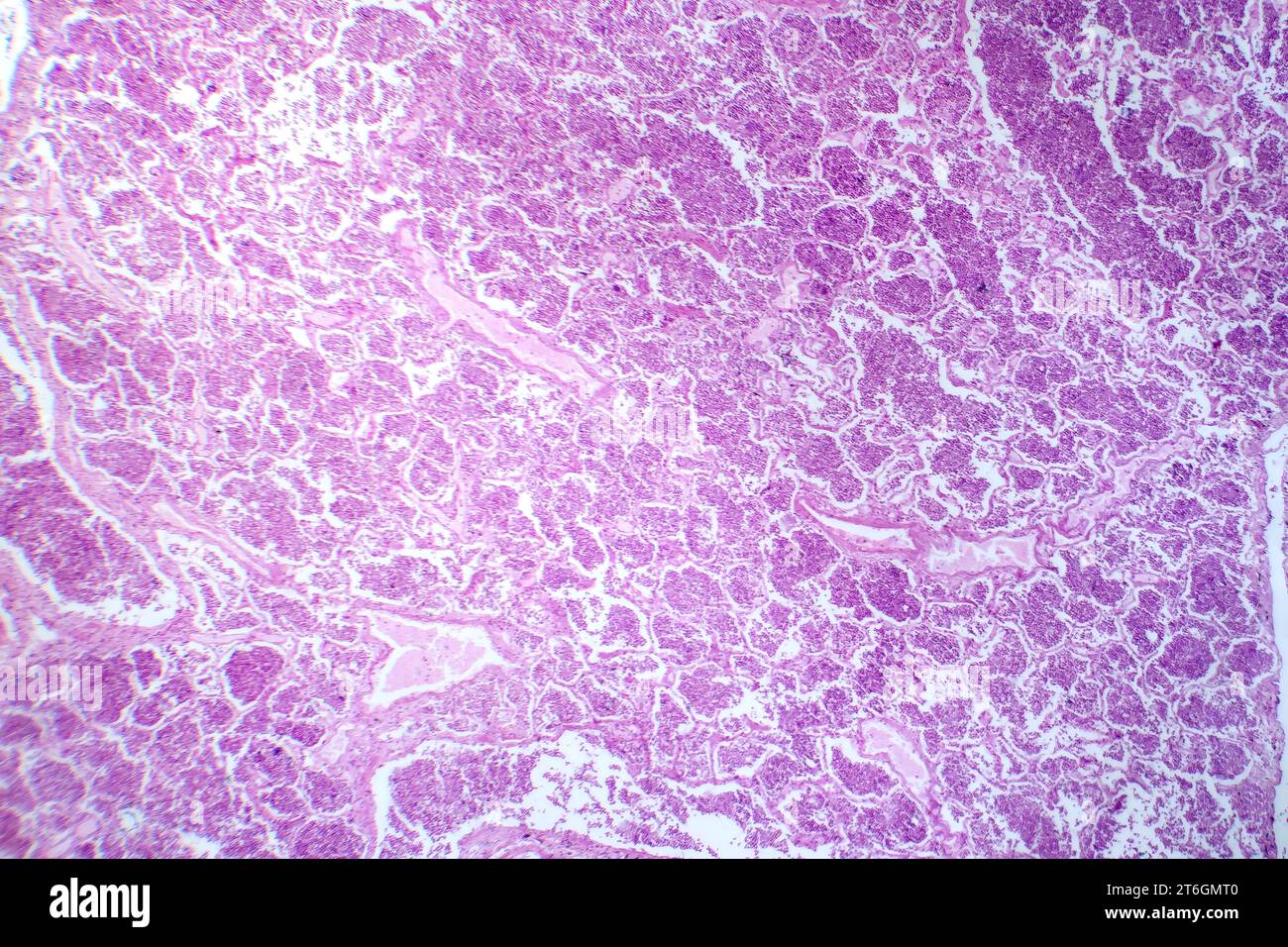 Photomicrograph of lobar pneumonia in grey hepatic phase, revealing ...