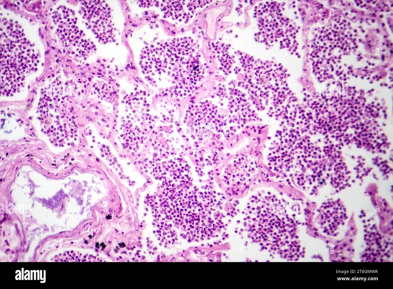 Photomicrograph of lobar pneumonia in grey hepatic phase, revealing ...