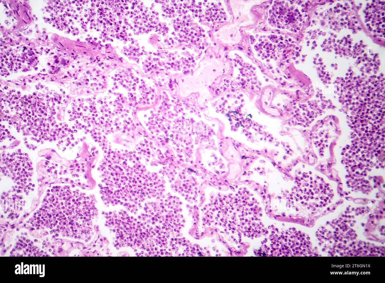 Photomicrograph of lobar pneumonia in grey hepatic phase, revealing ...