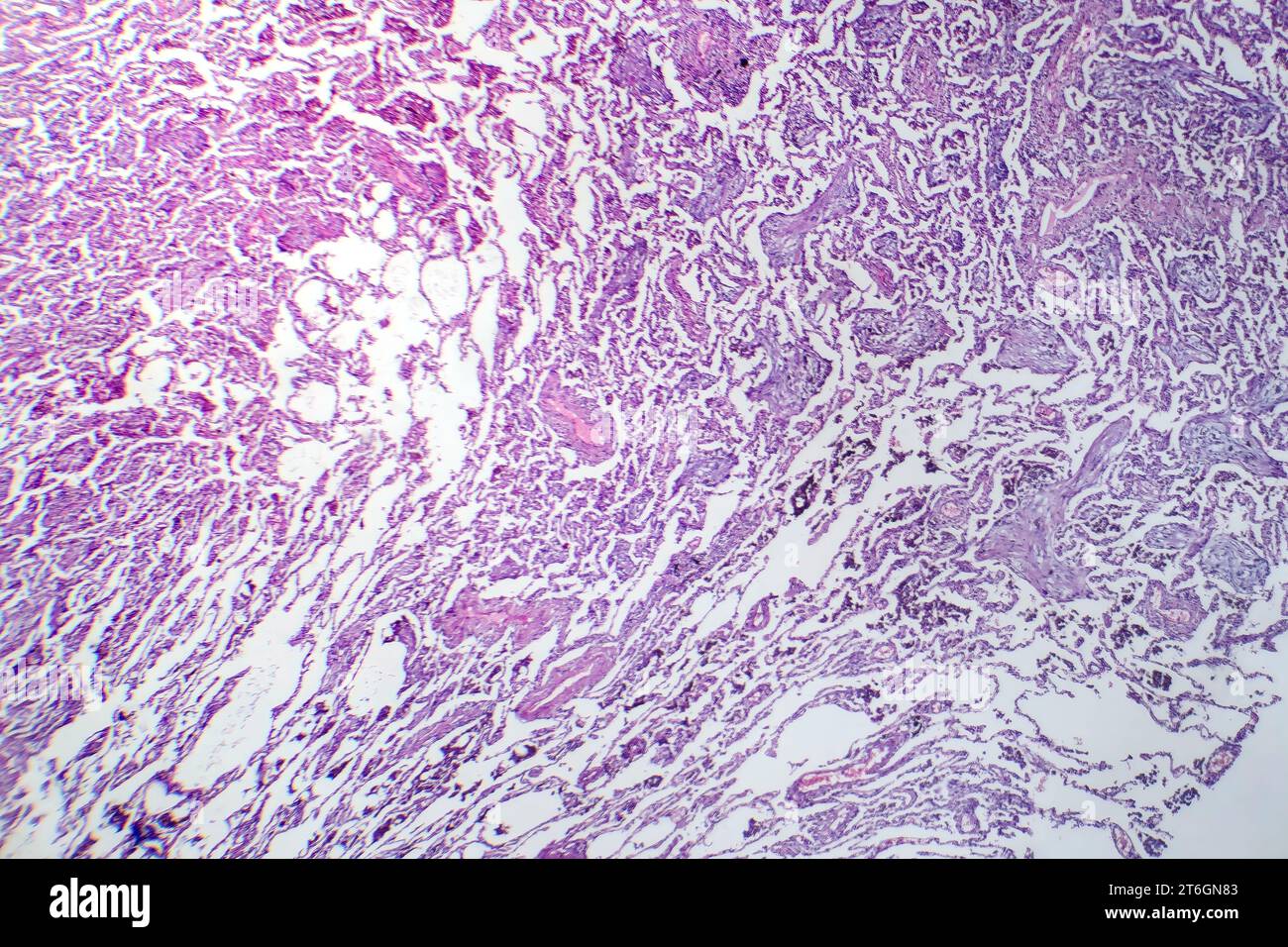 Photomicrograph of lobar pneumonia in dissolved dissipate period ...