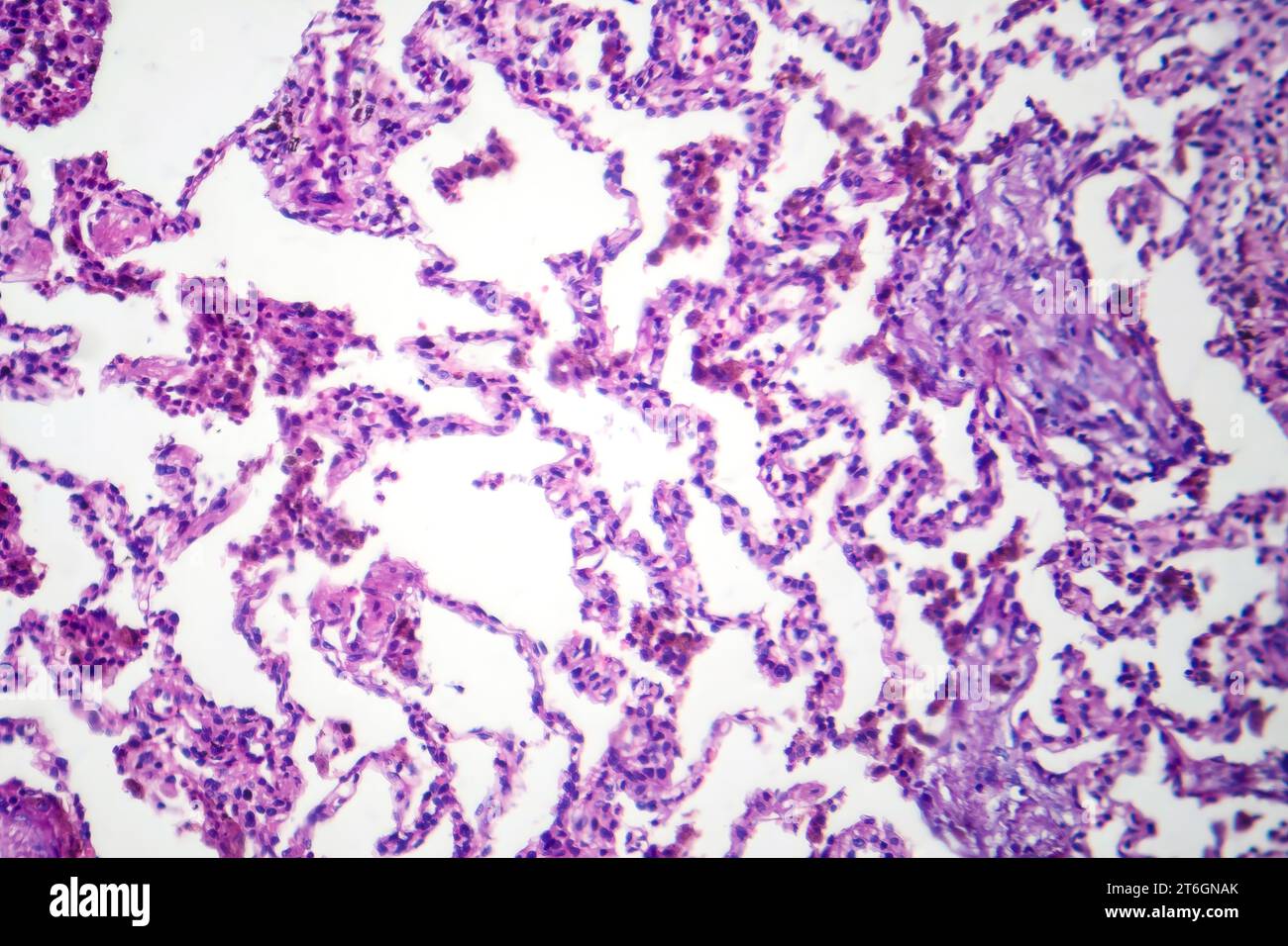 Photomicrograph of lobar pneumonia in dissolved dissipate period ...