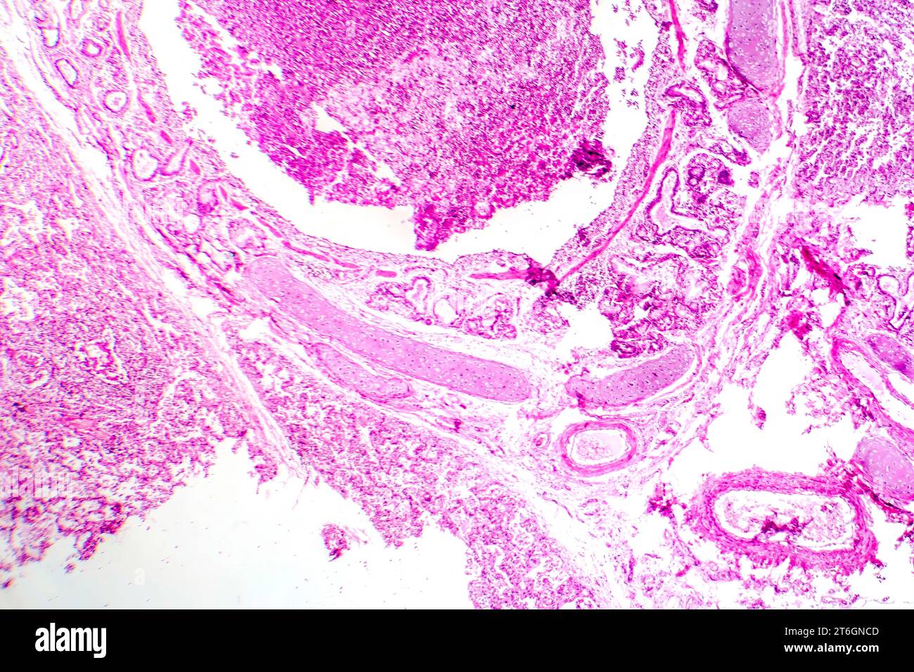 Photomicrograph of bronchopneumonia, illustrating inflammation and ...