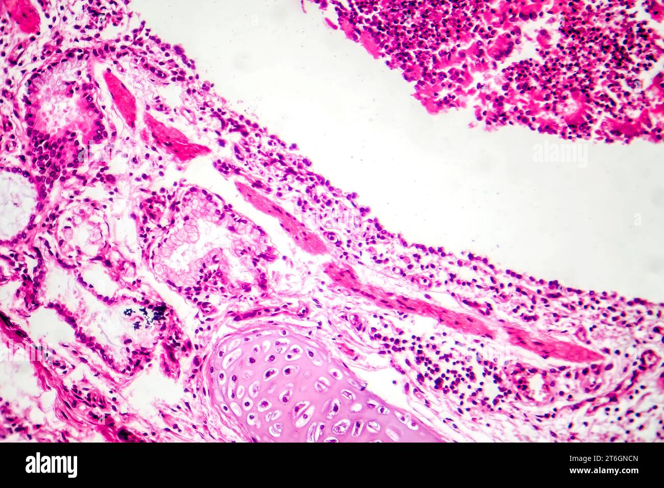 Photomicrograph of bronchopneumonia, illustrating inflammation and ...