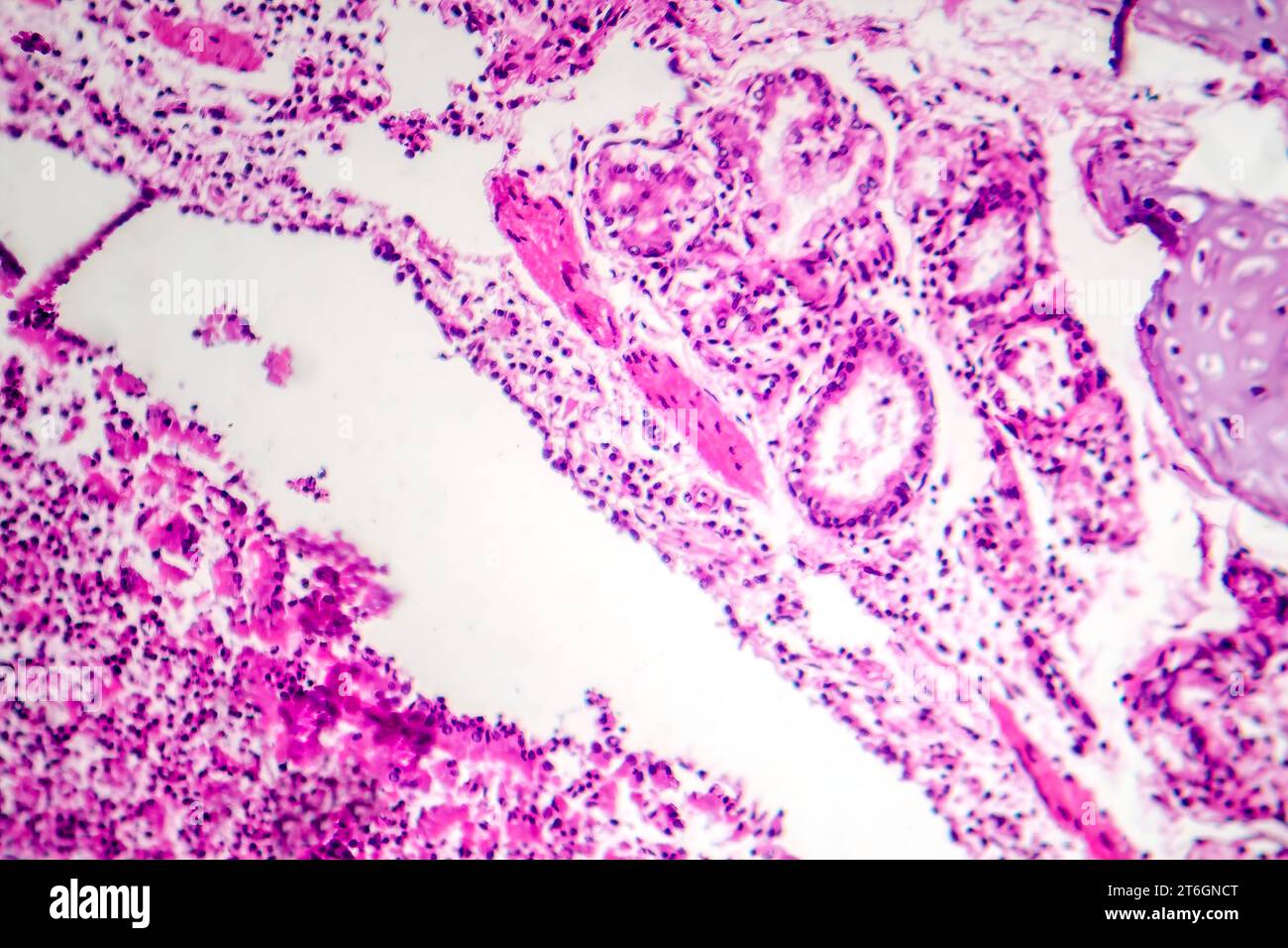 Photomicrograph of bronchopneumonia, illustrating inflammation and ...