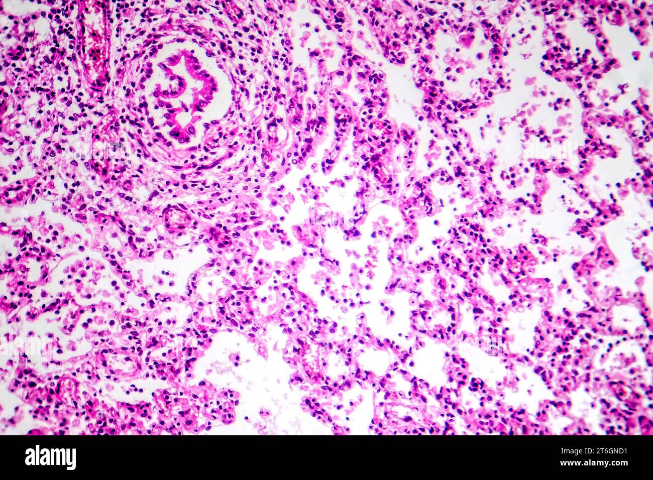 Photomicrograph of bronchopneumonia, illustrating inflammation and ...