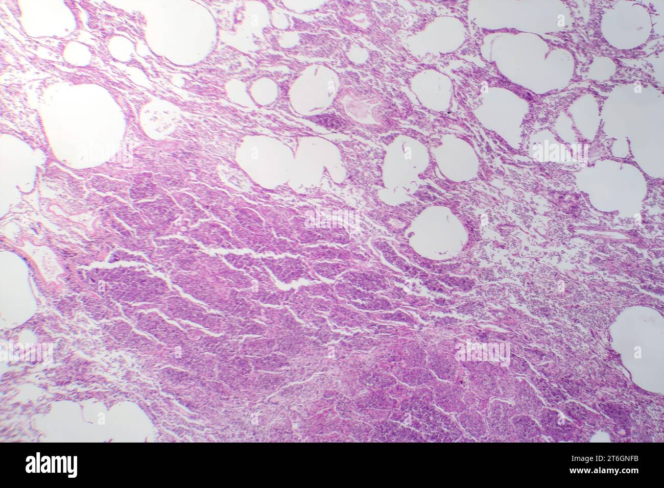 Photomicrograph of interstitial pneumonia, showing inflammation and ...