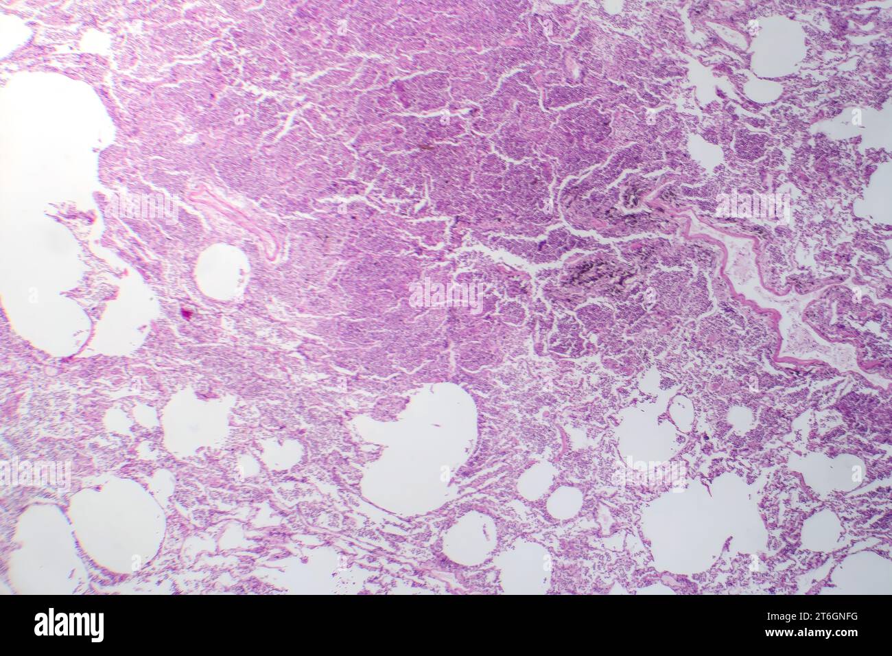 Photomicrograph of interstitial pneumonia, showing inflammation and ...