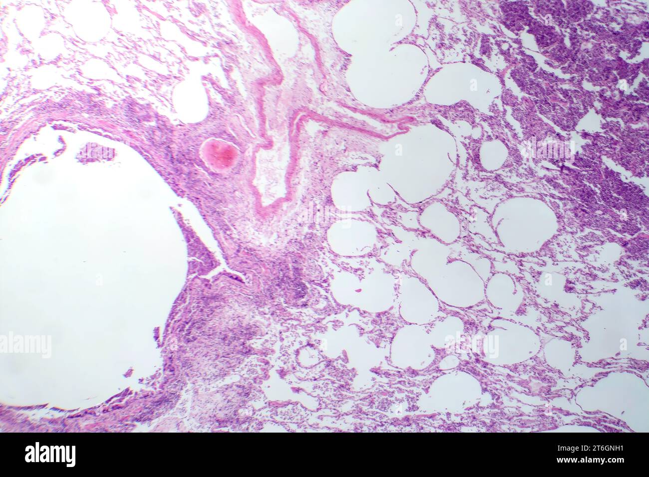 Photomicrograph of interstitial pneumonia, showing inflammation and ...