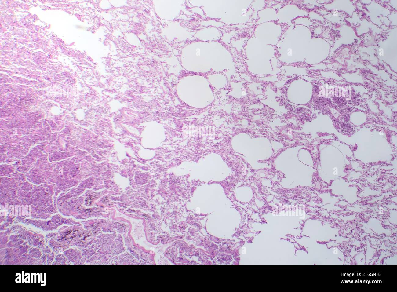 Photomicrograph of interstitial pneumonia, showing inflammation and ...