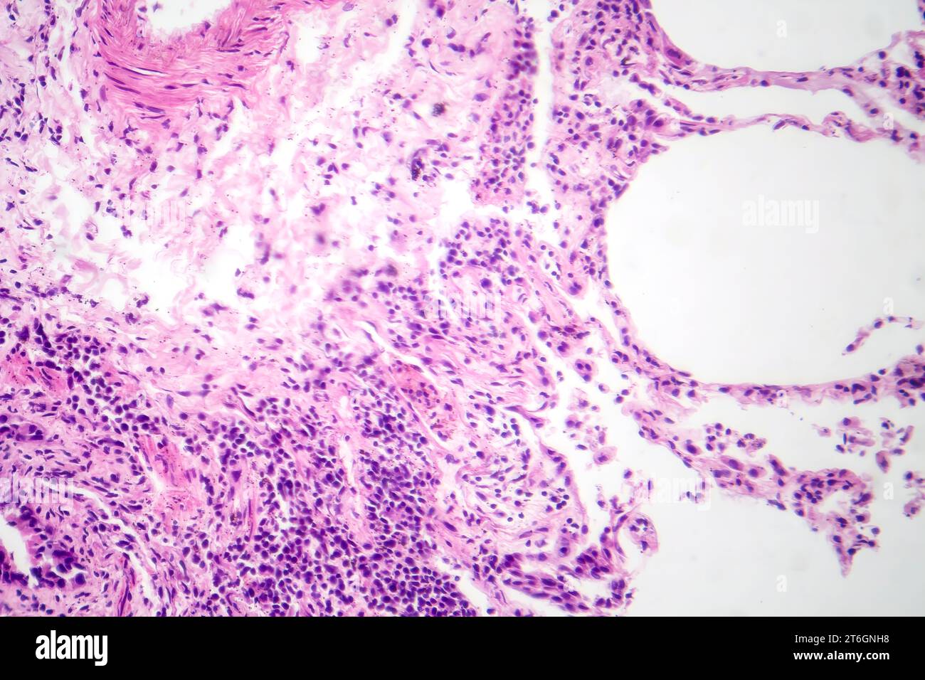 Photomicrograph of interstitial pneumonia, showing inflammation and ...