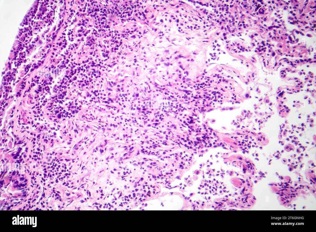 Photomicrograph of interstitial pneumonia, showing inflammation and ...