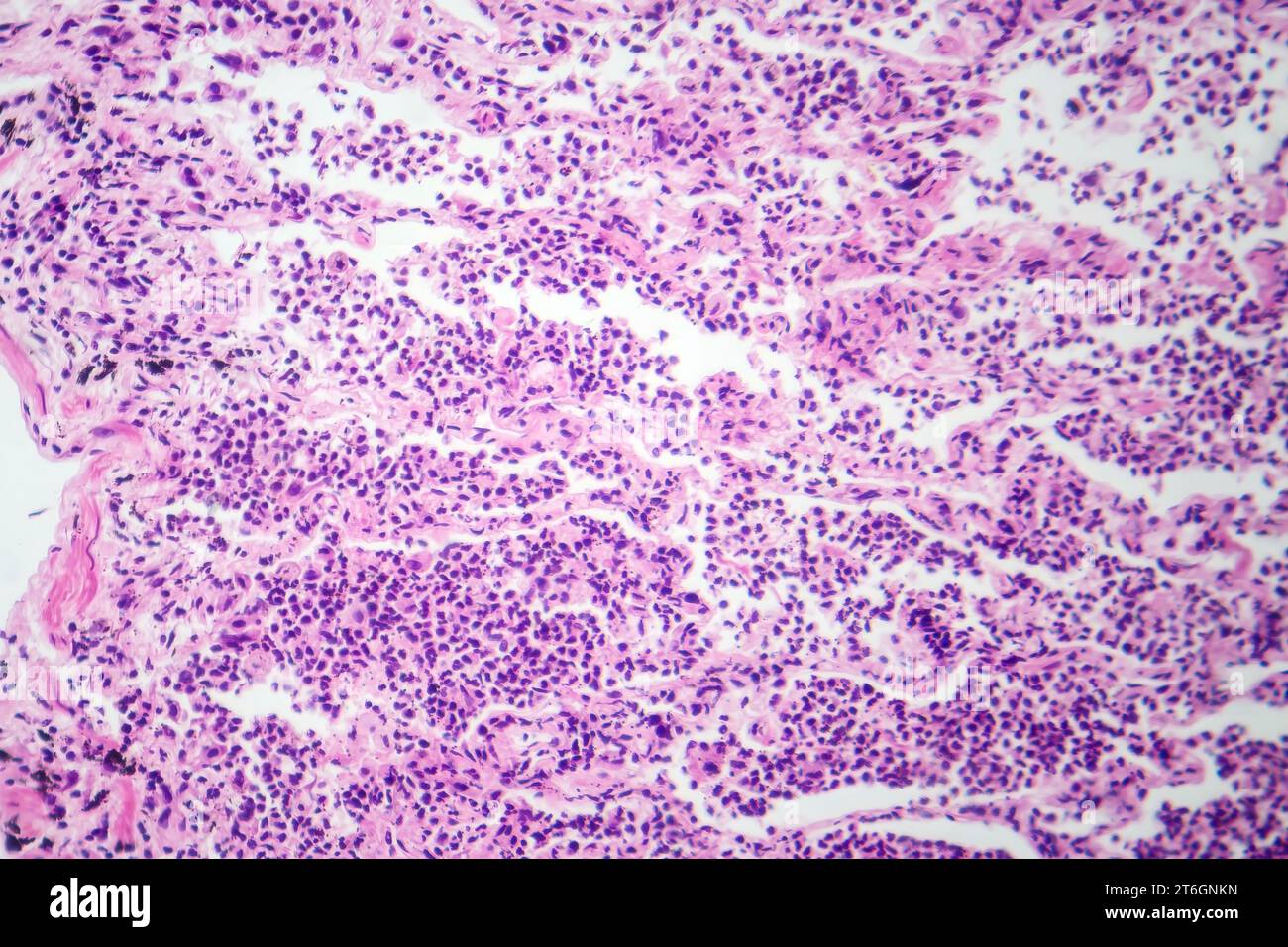 Photomicrograph of interstitial pneumonia, showing inflammation and ...