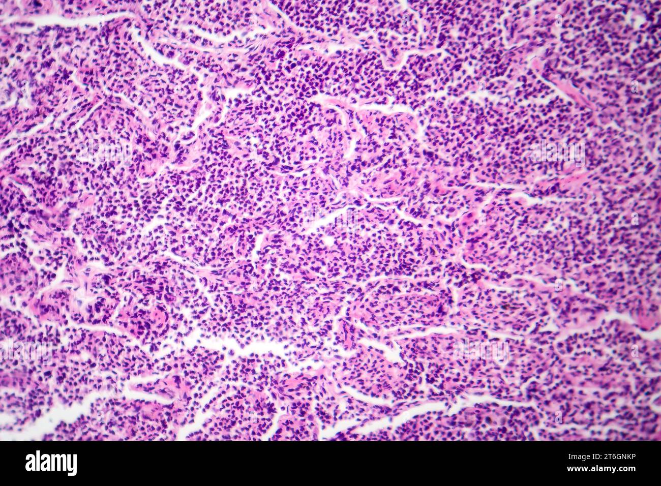 Photomicrograph of interstitial pneumonia, showing inflammation and ...