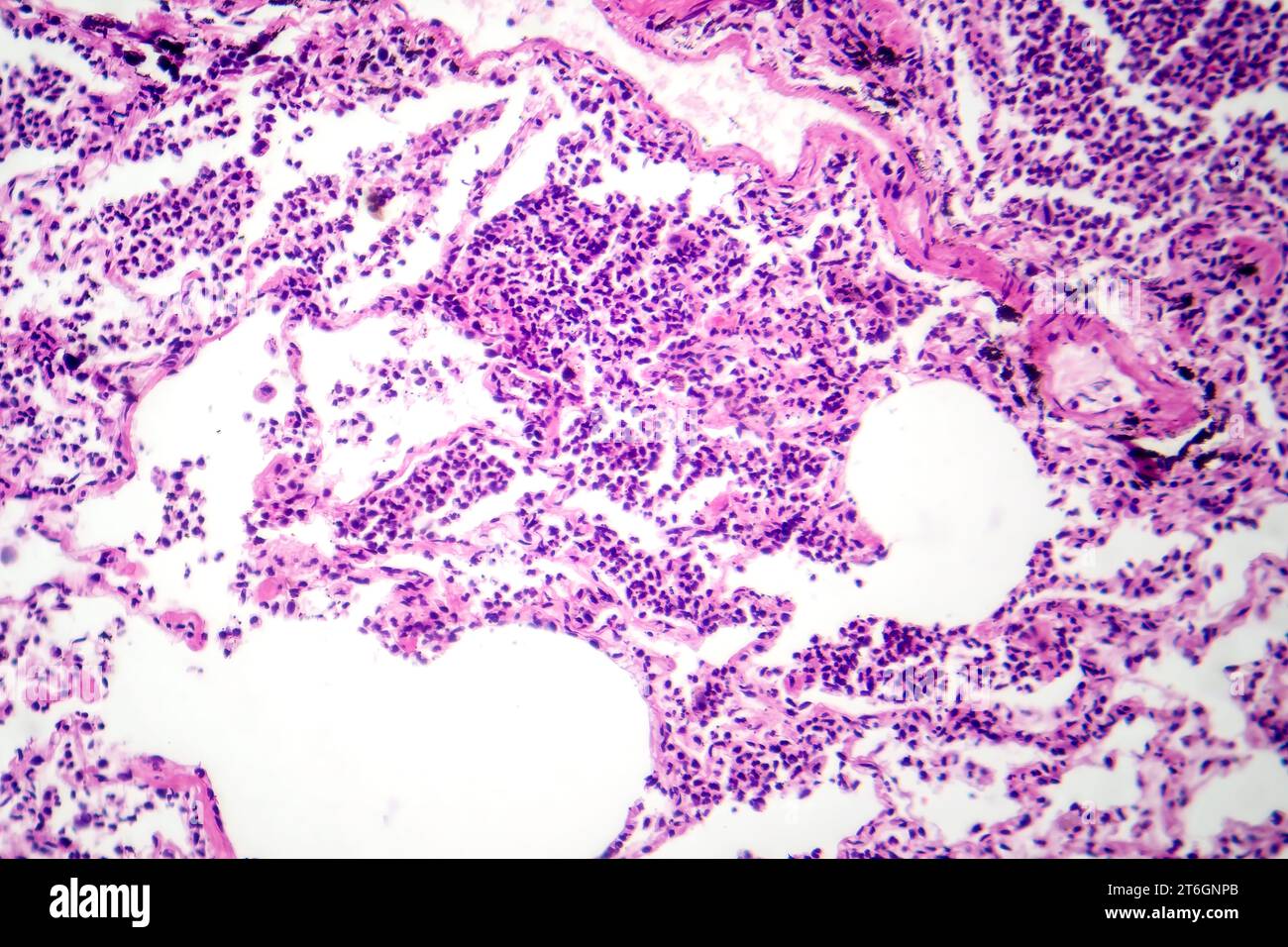 Photomicrograph of interstitial pneumonia, showing inflammation and ...