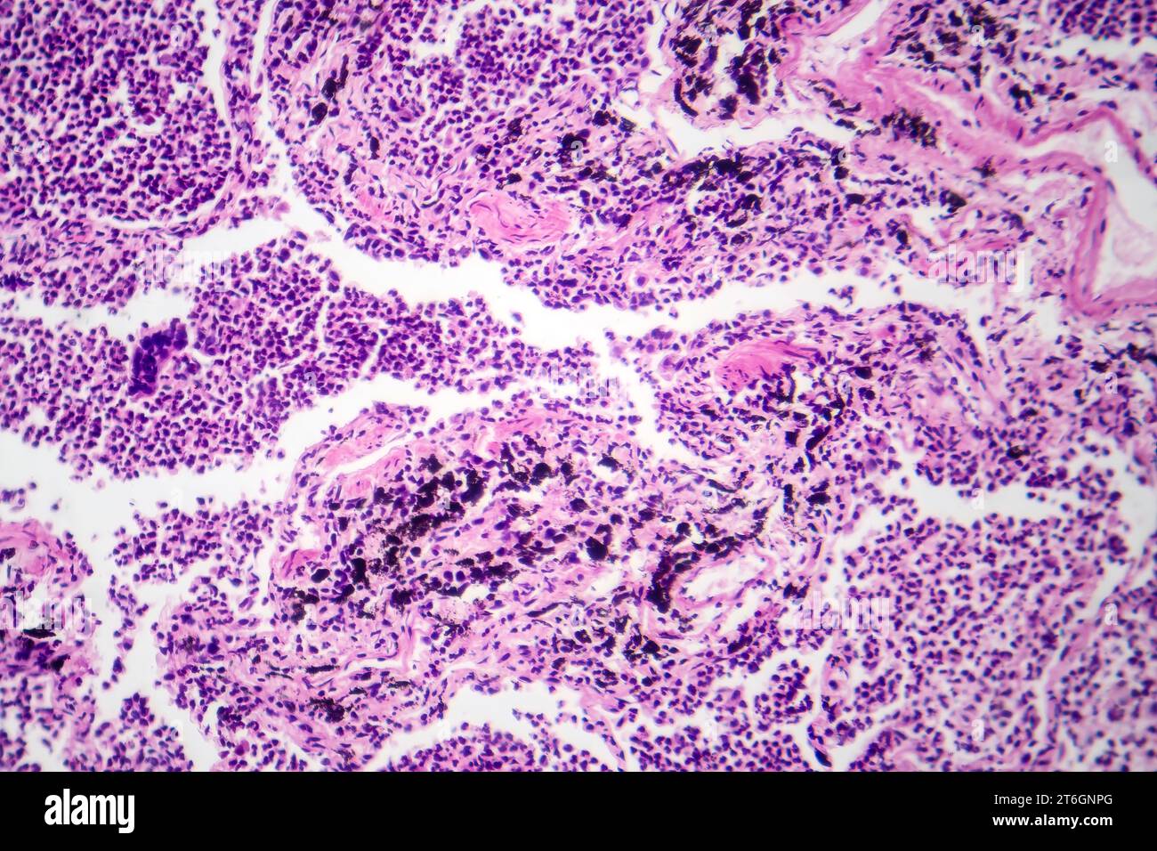 Photomicrograph of interstitial pneumonia, showing inflammation and ...