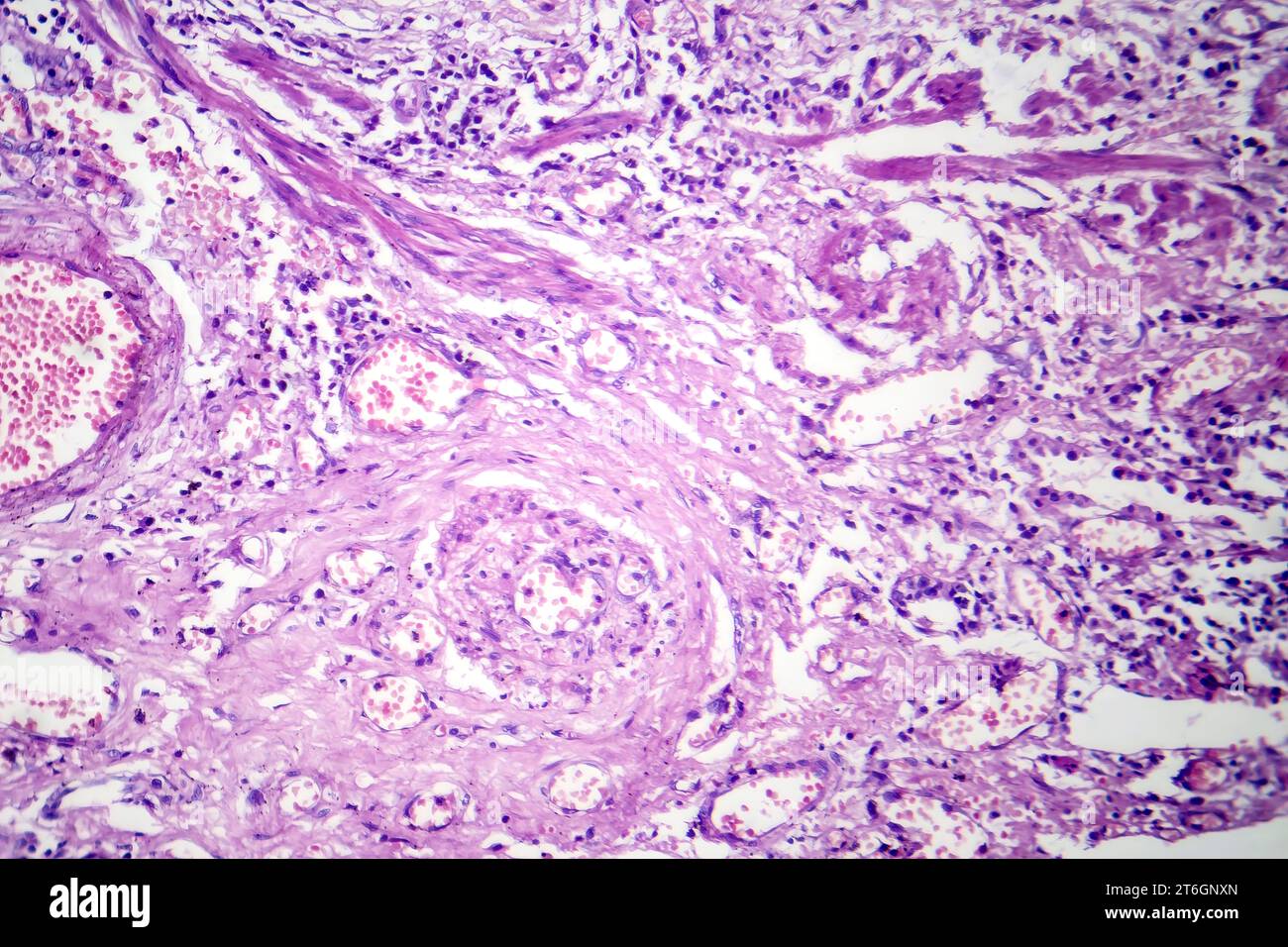 Respiratory bronchioles hi-res stock photography and images - Alamy