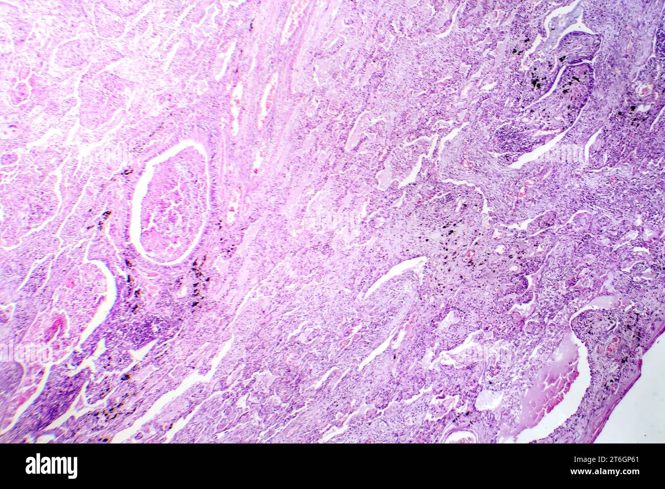 Photomicrograph of squamous cell carcinoma of the lung, showing ...