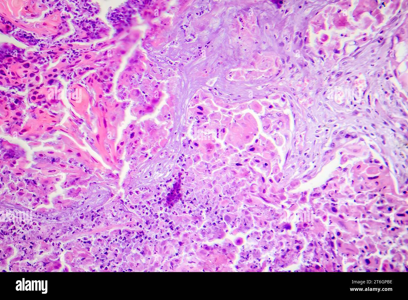 Photomicrograph of squamous cell carcinoma of the lung, showing malignant squamous cells in lung ...