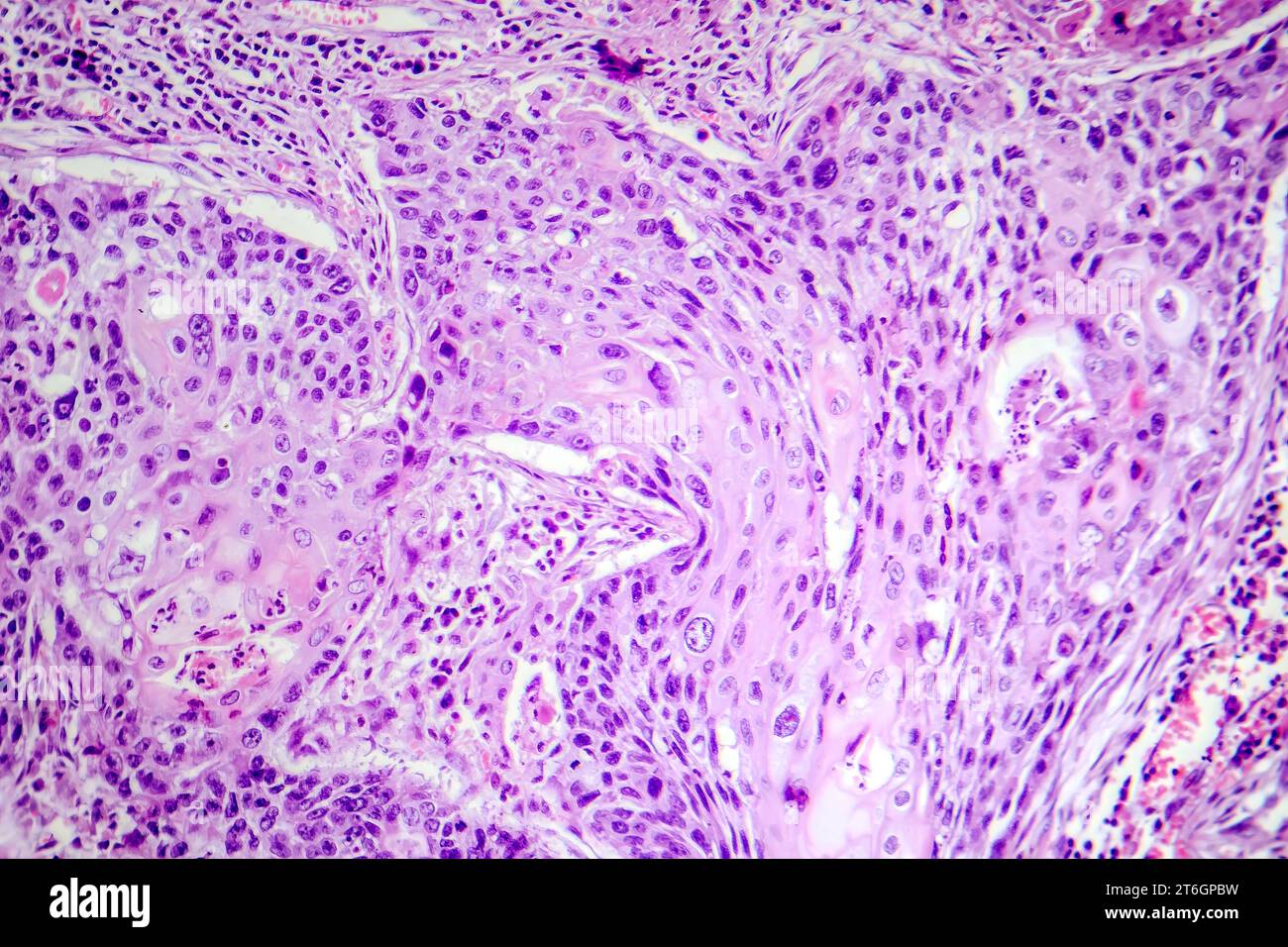 Photomicrograph of squamous cell carcinoma of the lung, showing ...