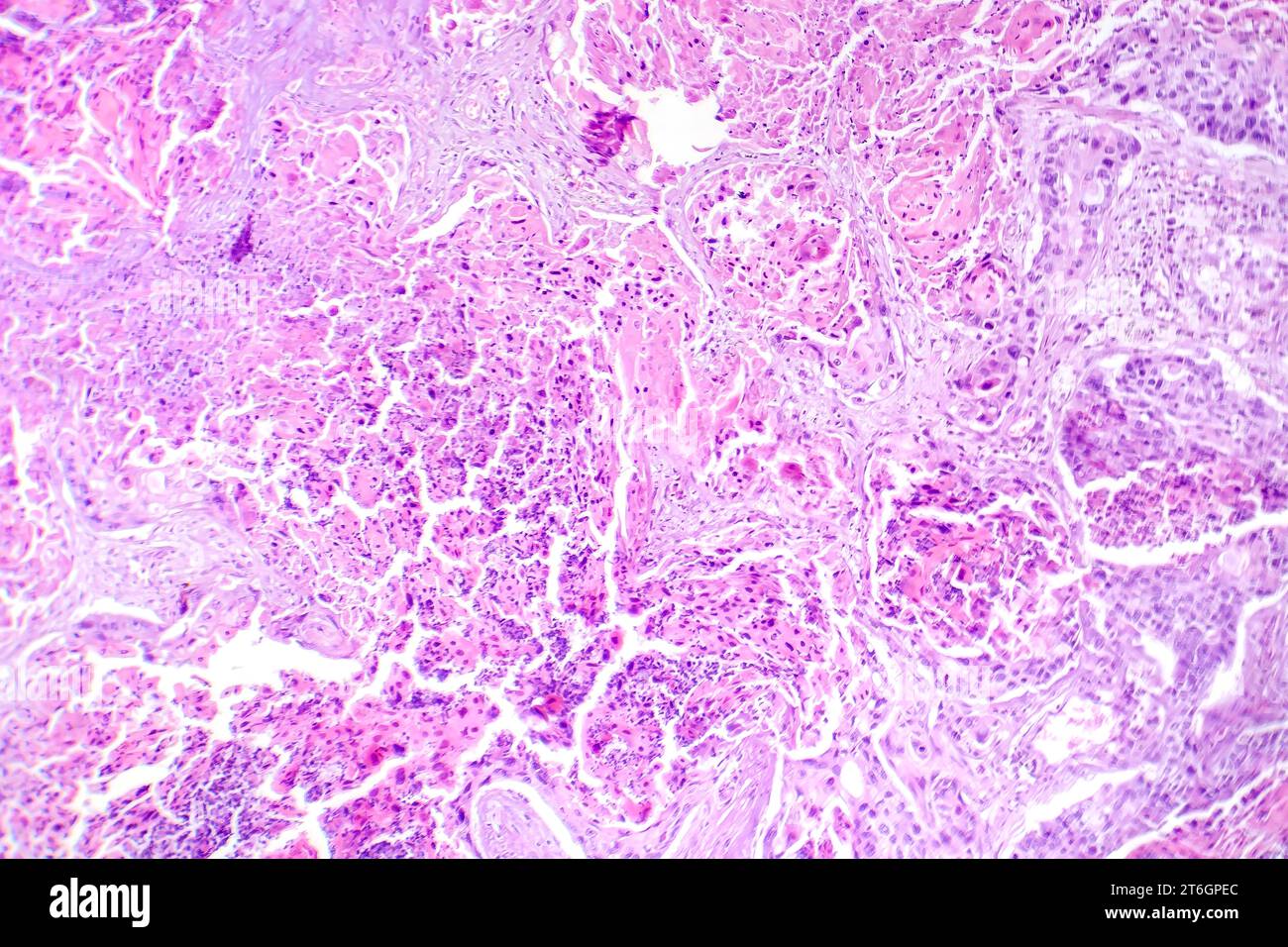 Photomicrograph of squamous cell carcinoma of the lung, showing malignant squamous cells in lung ...