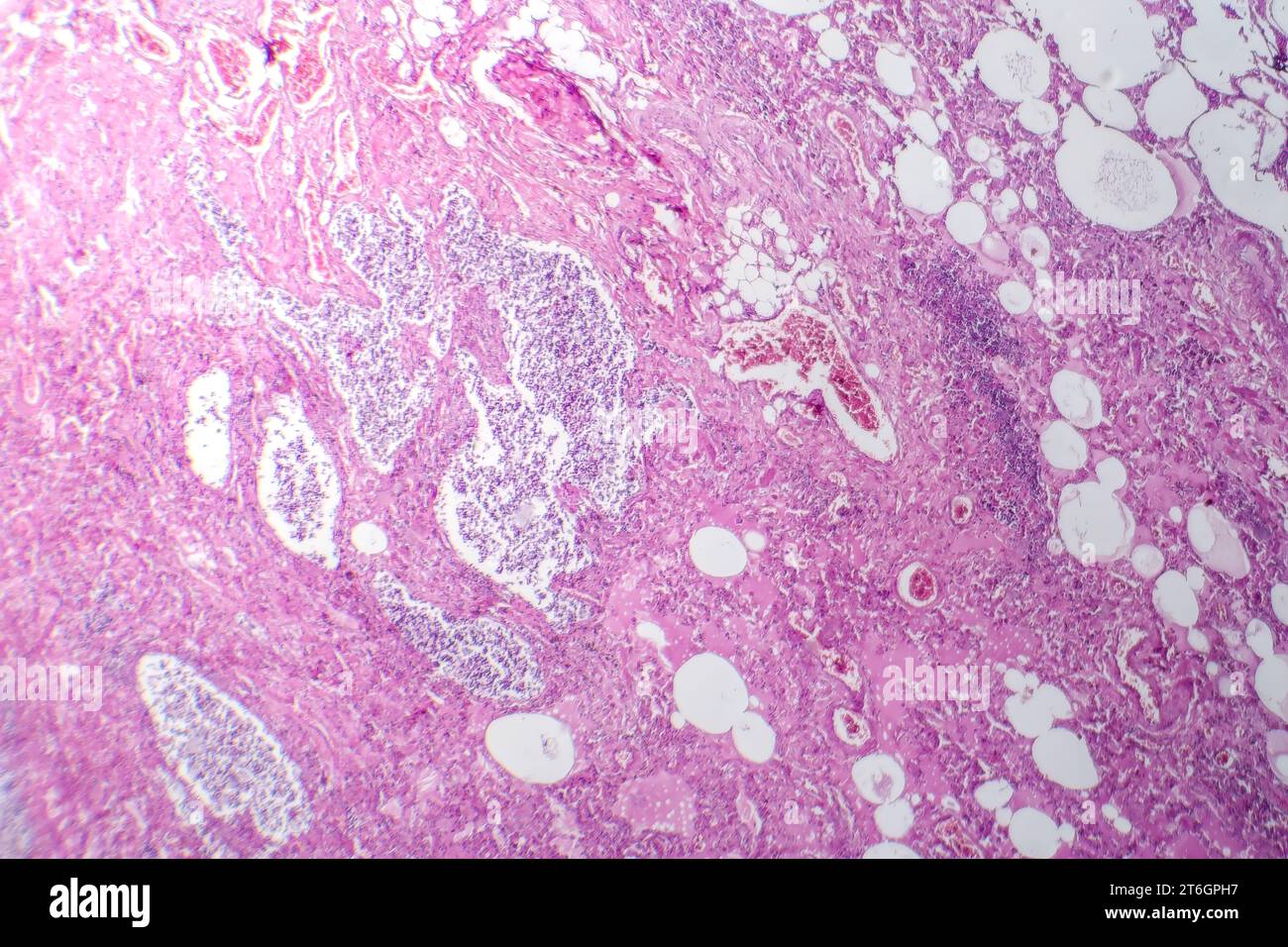 Photomicrograph of small cell lung cancer, revealing densely packed ...