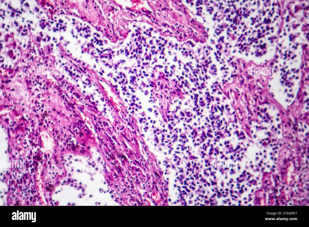 Photomicrograph of small cell lung cancer, revealing densely packed ...