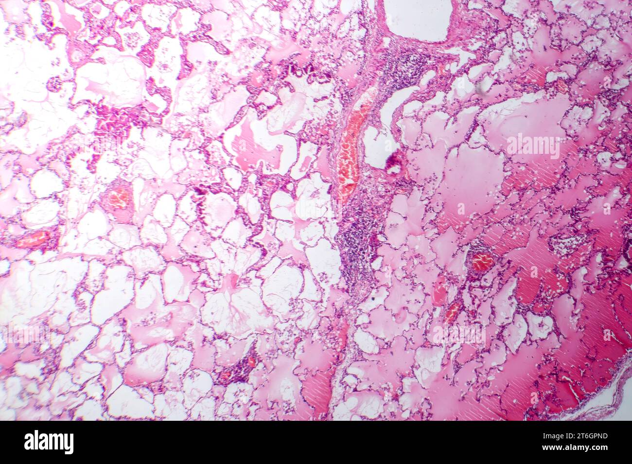 Photomicrograph of lung adenocarcinoma, displaying malignant glandular ...