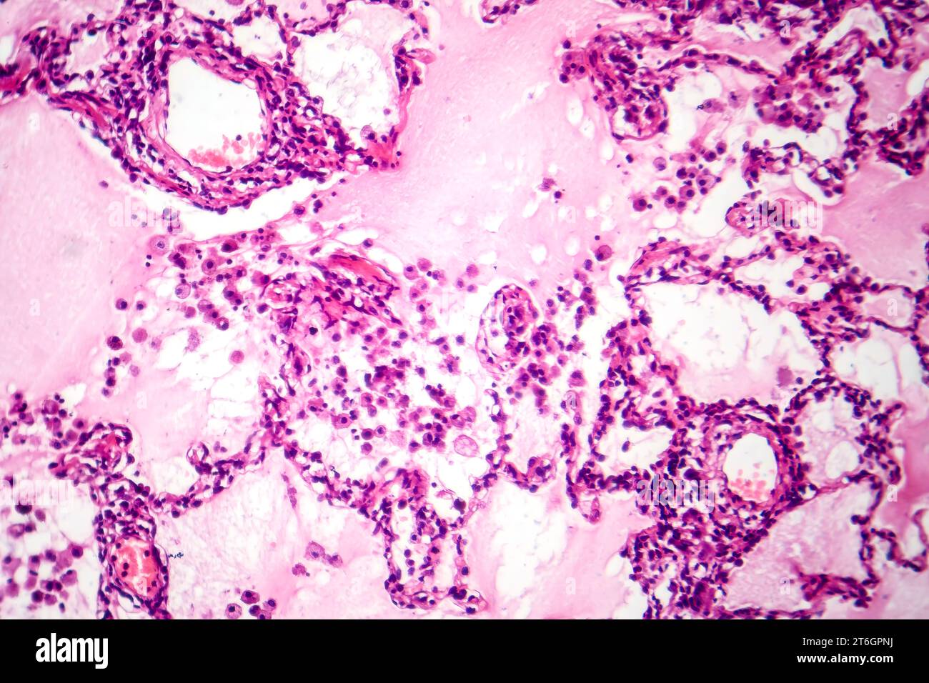 Photomicrograph of lung adenocarcinoma, displaying malignant glandular ...