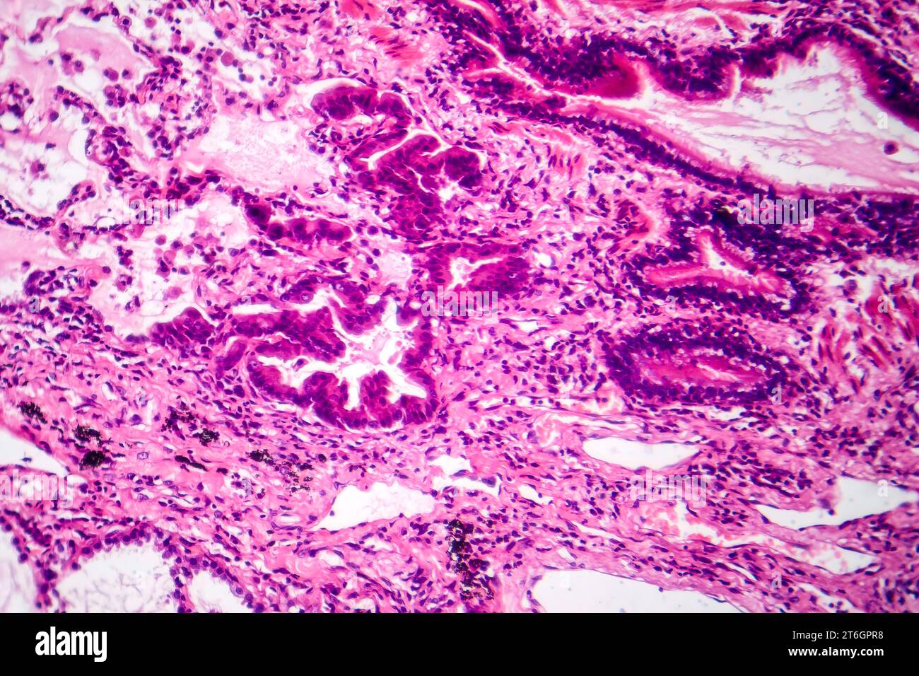 Photomicrograph of lung adenocarcinoma, displaying malignant glandular ...