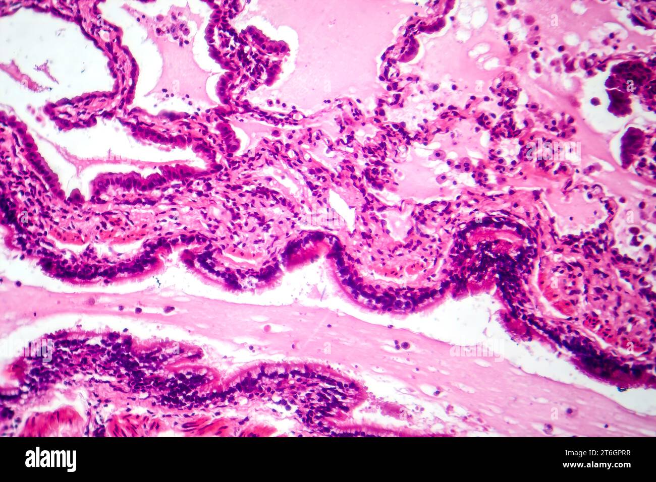 Photomicrograph of lung adenocarcinoma, displaying malignant glandular ...