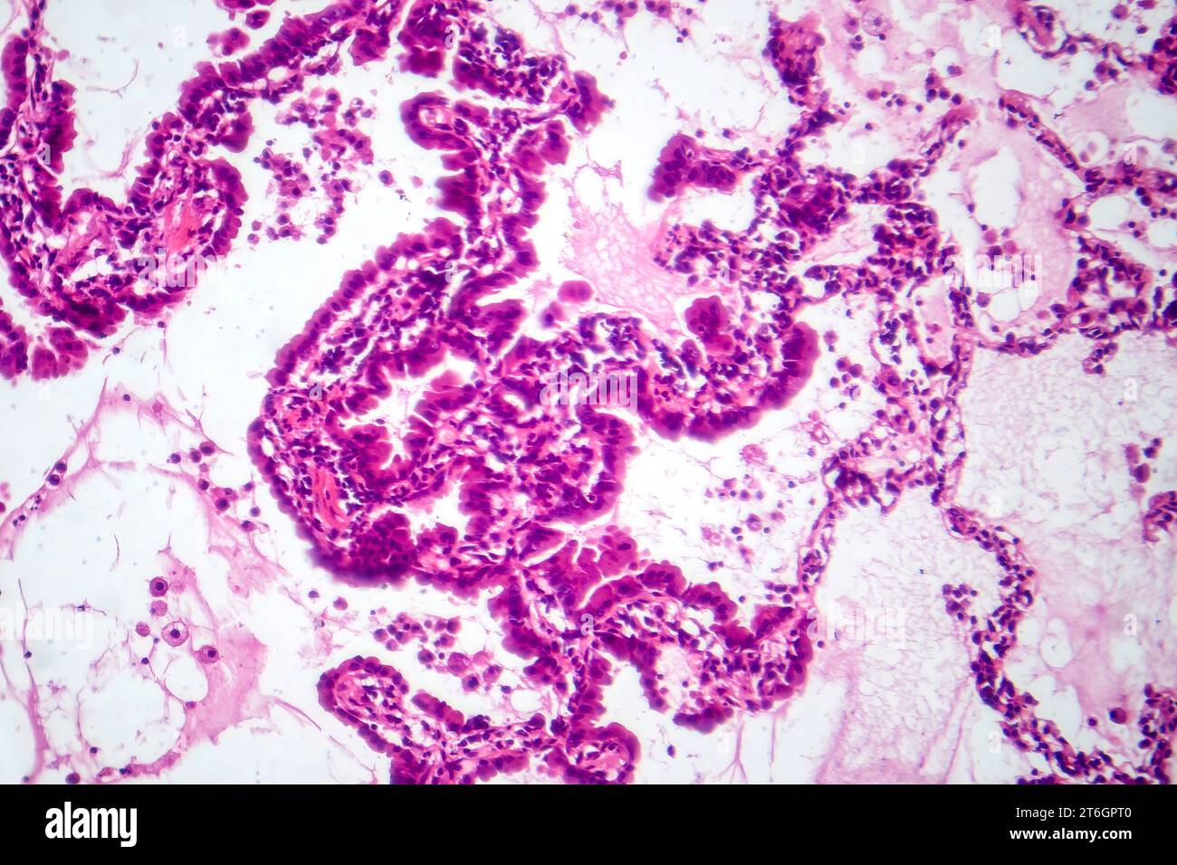 Photomicrograph of lung adenocarcinoma, displaying malignant glandular ...