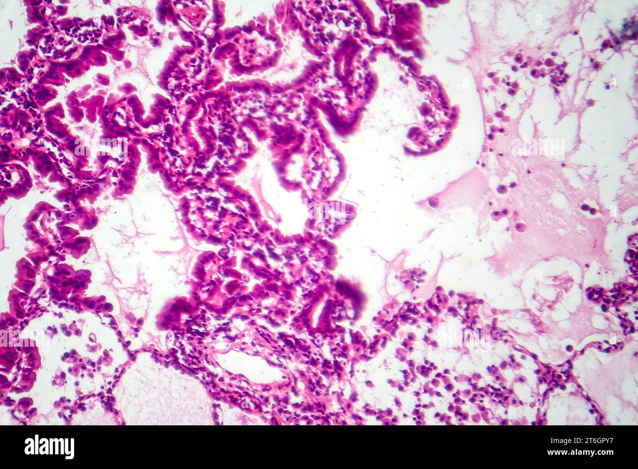 Photomicrograph of lung adenocarcinoma, displaying malignant glandular ...