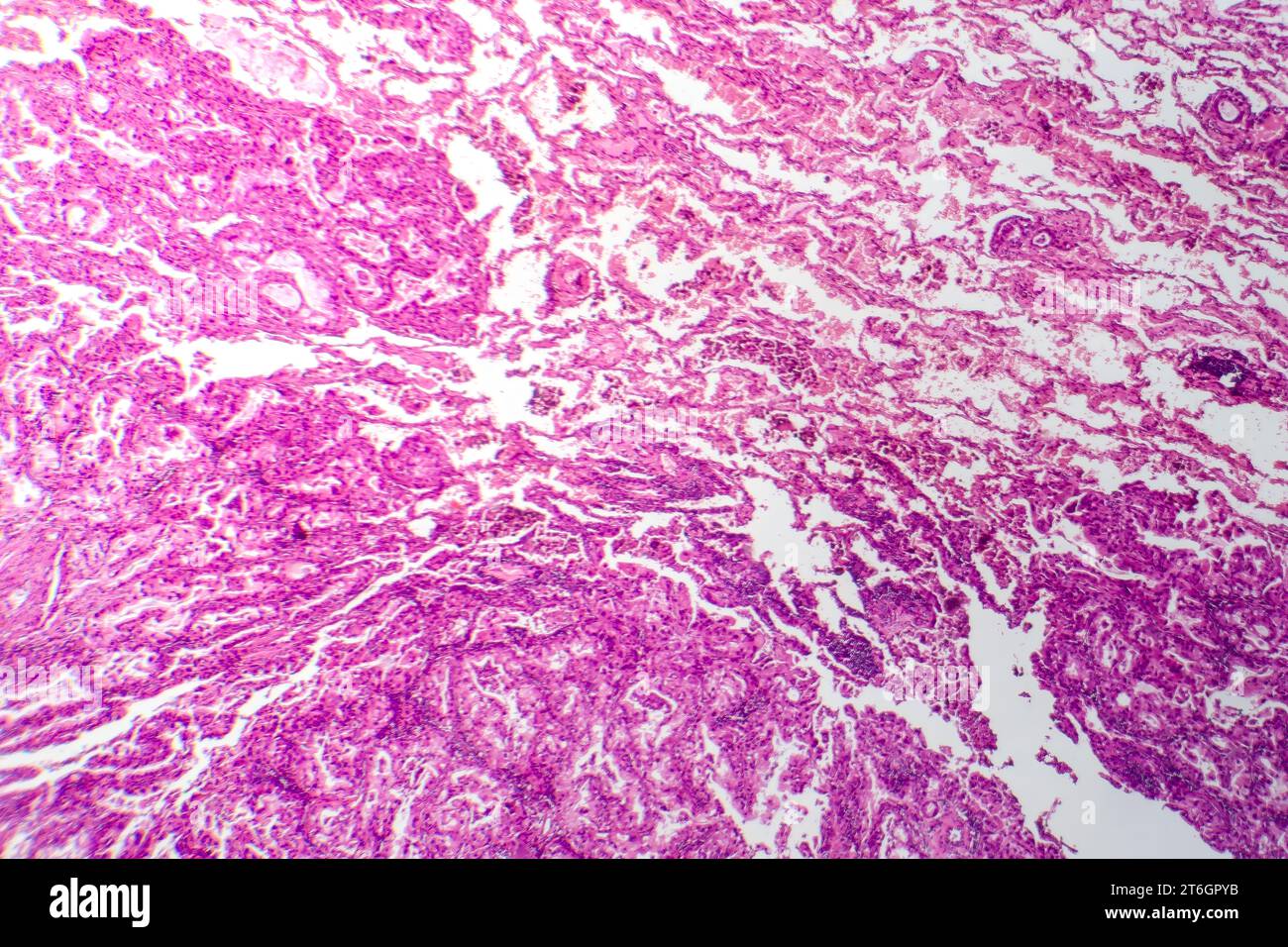 Photomicrograph of lung cancer tissue, revealing malignant cells and ...