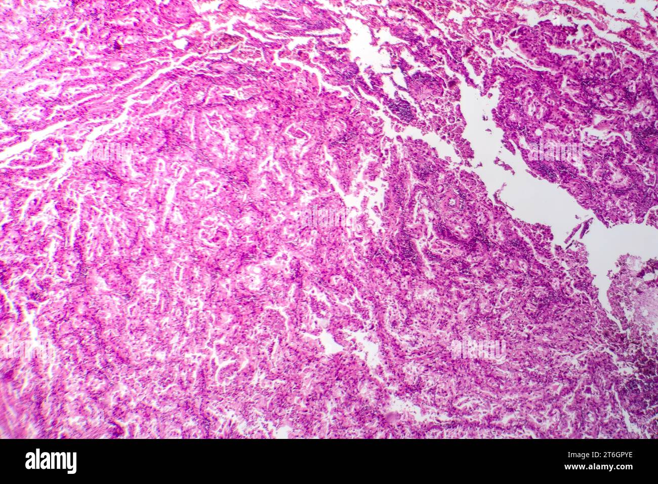 Photomicrograph of lung cancer tissue, revealing malignant cells and ...