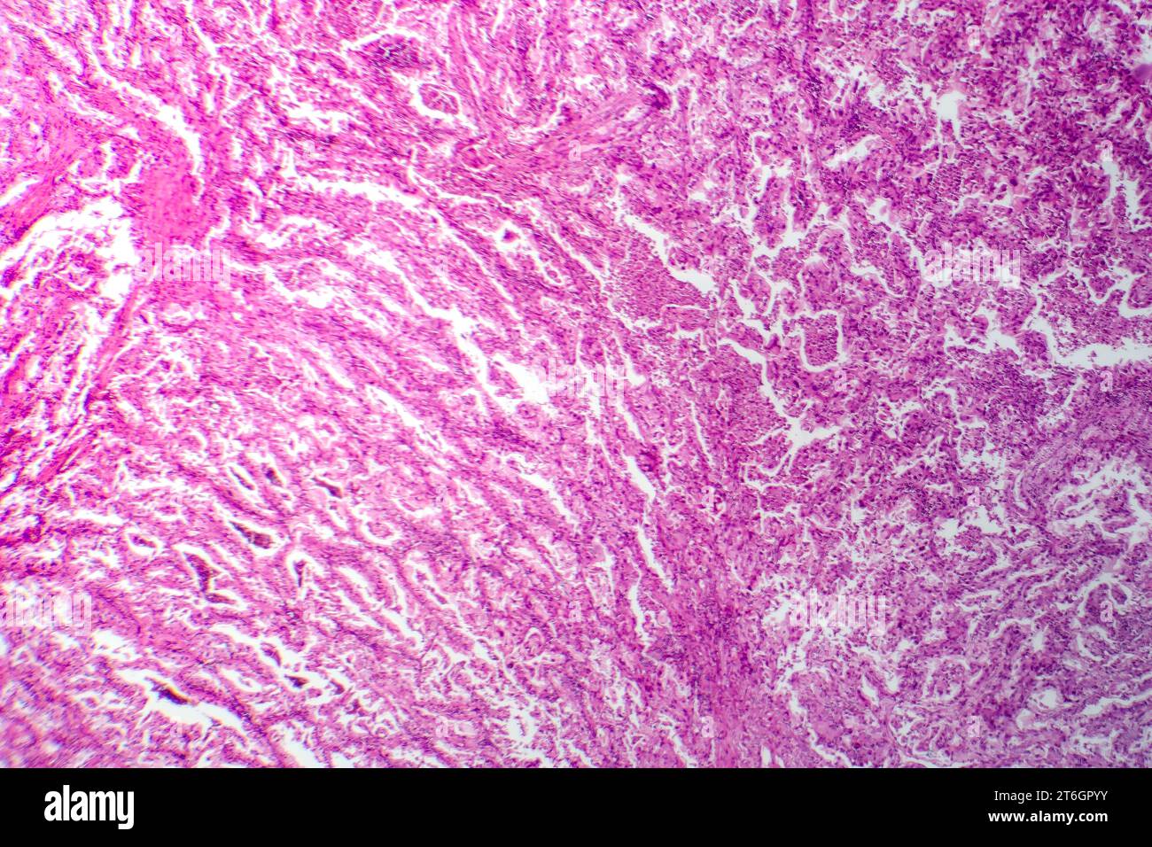 Photomicrograph of lung cancer tissue, revealing malignant cells and ...
