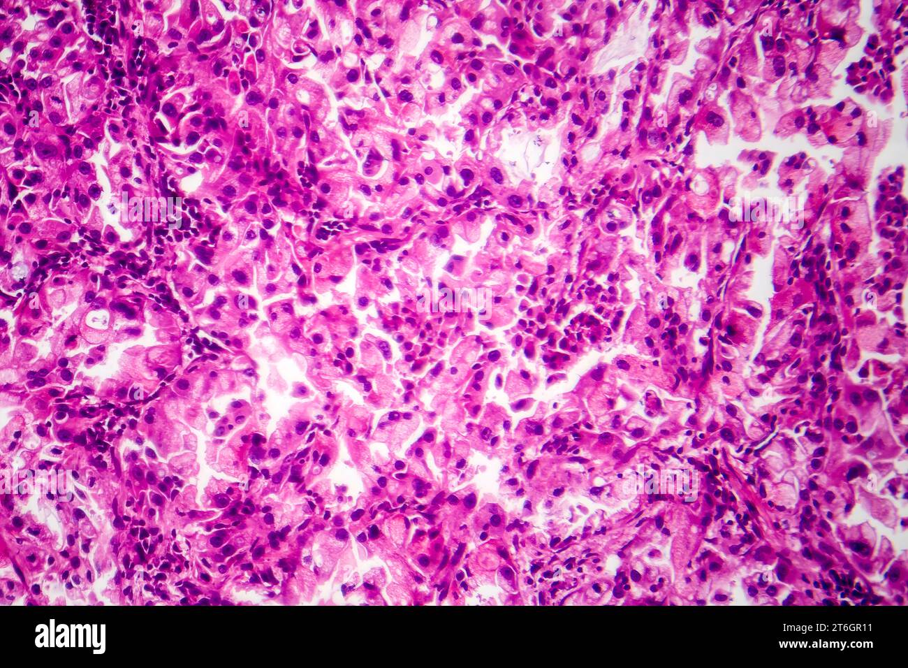 Photomicrograph of lung cancer tissue, revealing malignant cells and ...