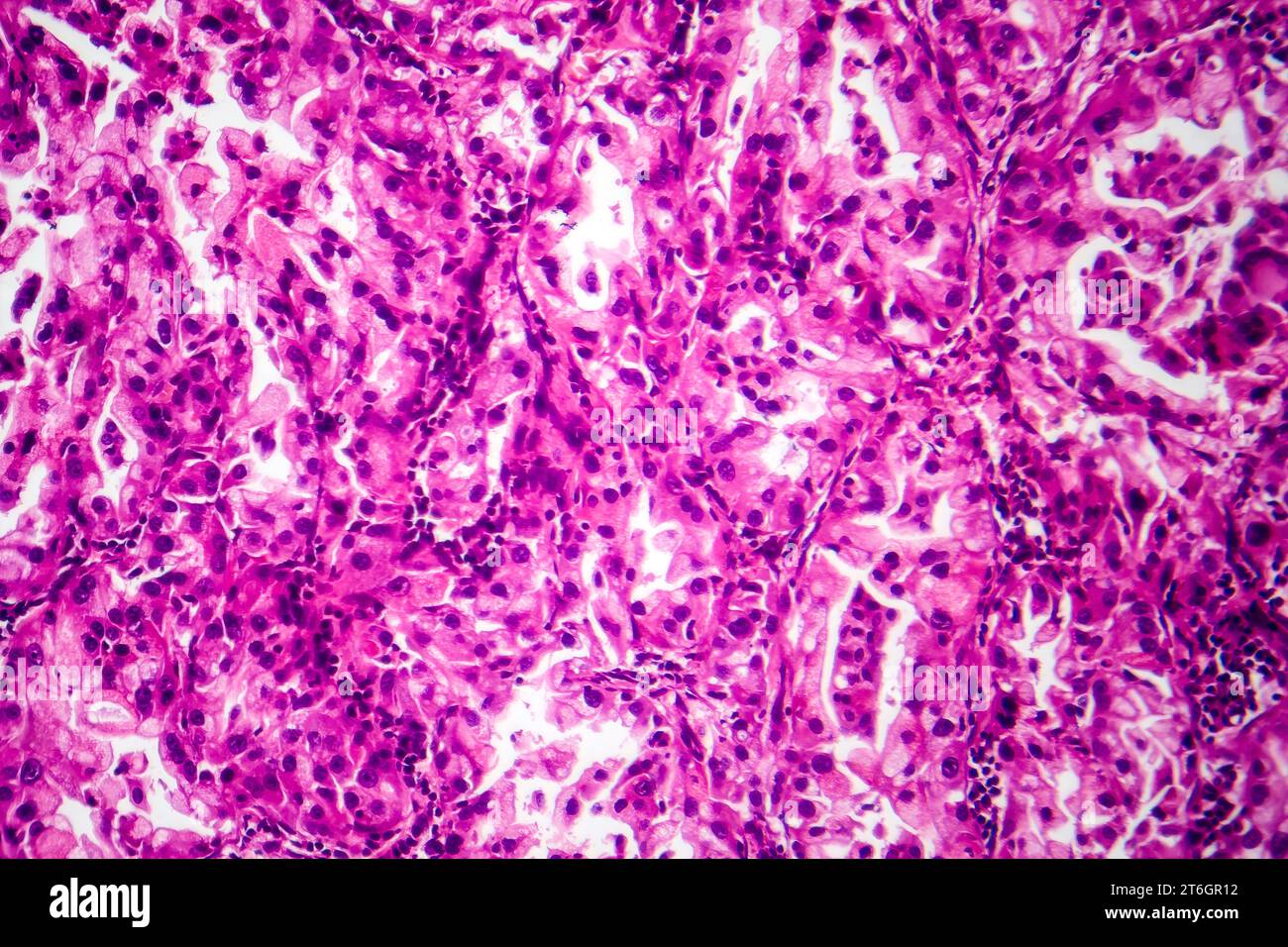 Photomicrograph of lung cancer tissue, revealing malignant cells and ...
