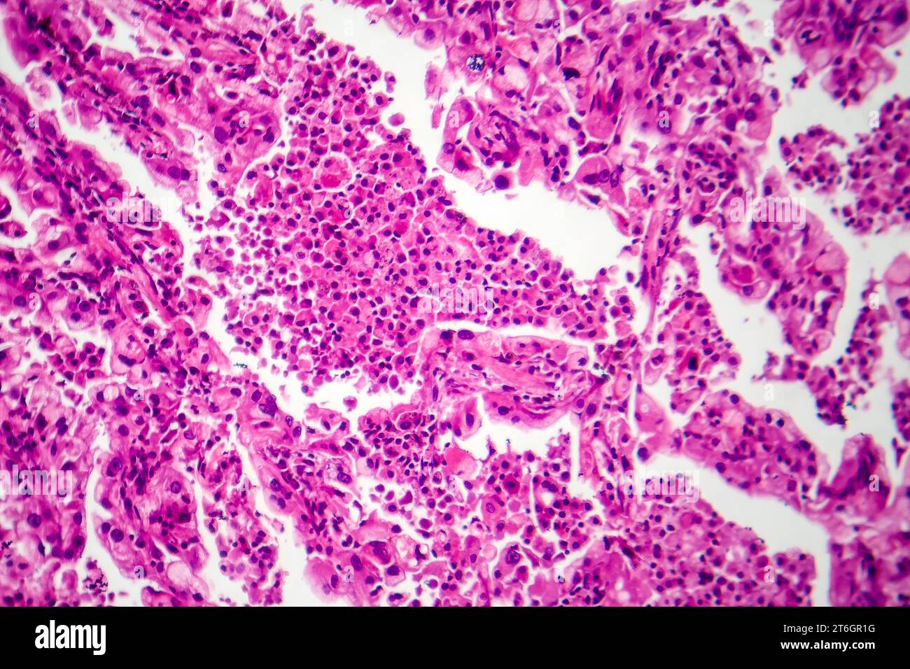Photomicrograph of lung cancer tissue, revealing malignant cells and ...
