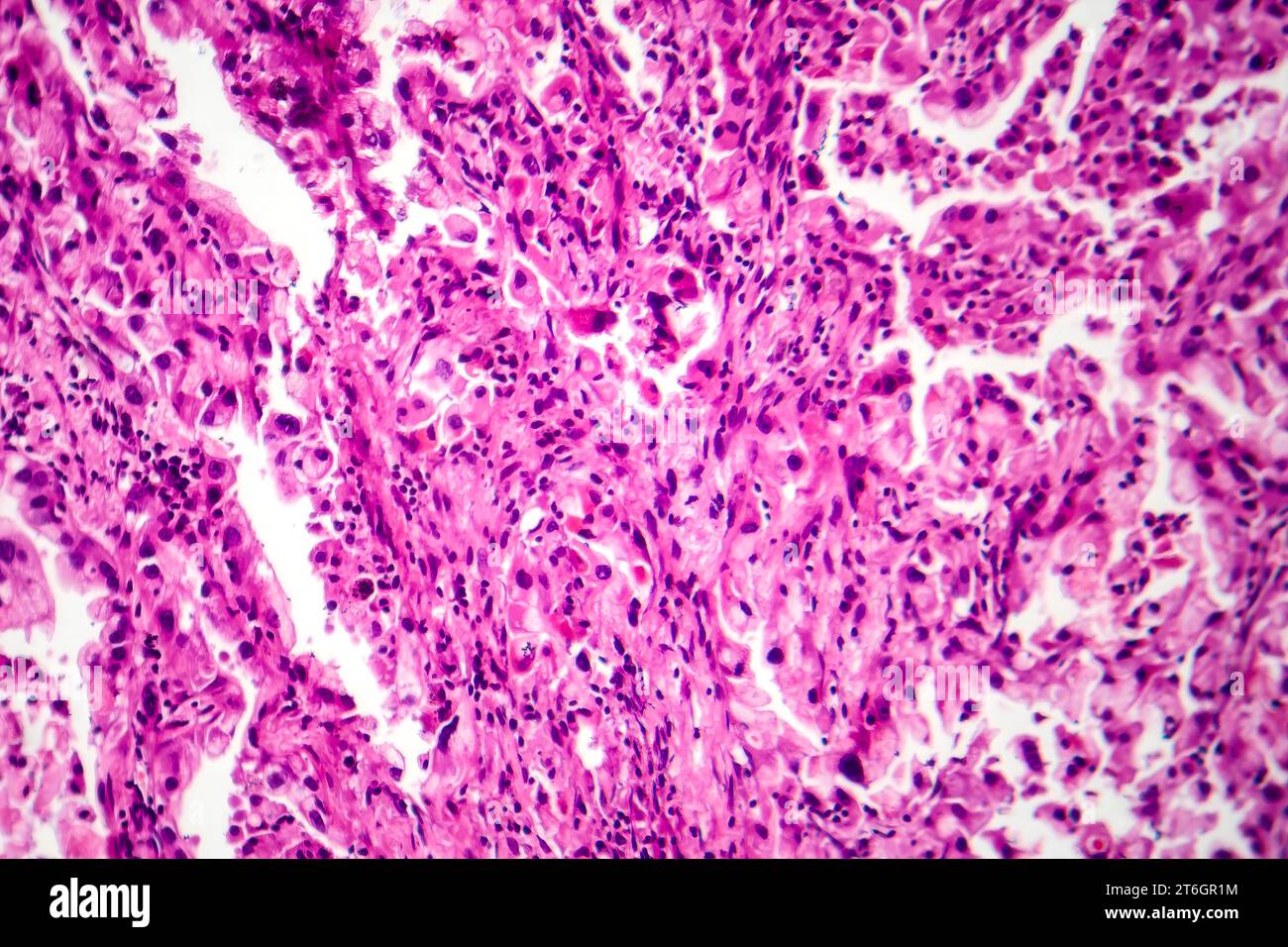 Photomicrograph of lung cancer tissue, revealing malignant cells and ...