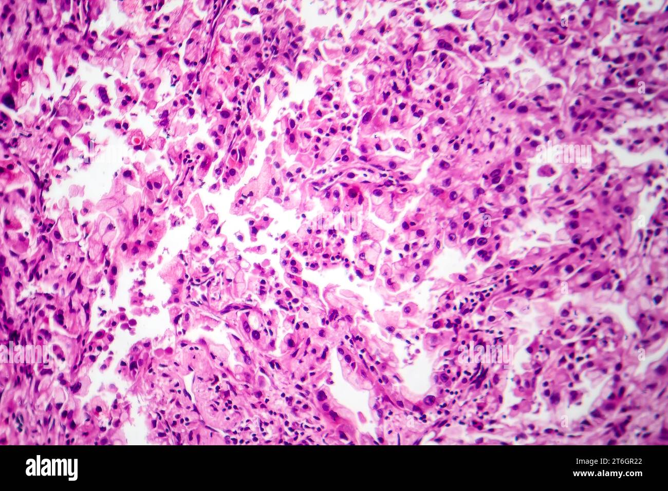 Photomicrograph of lung cancer tissue, revealing malignant cells and ...