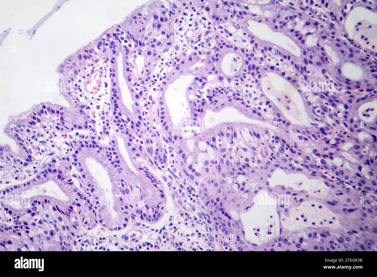 Photomicrograph of nasal polyps, displaying abnormal tissue growth in ...
