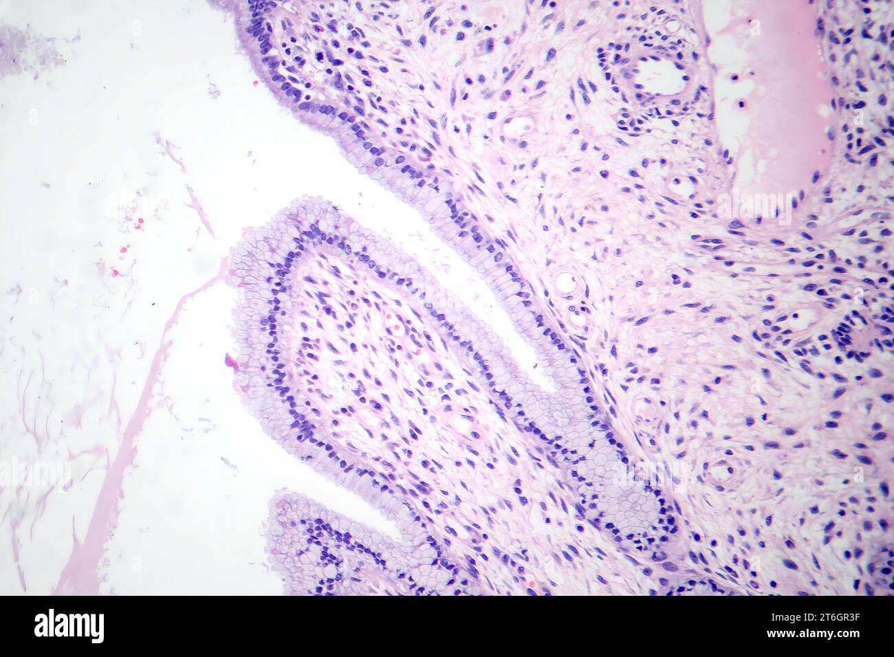 Photomicrograph of nasal polyps, displaying abnormal tissue growth in ...