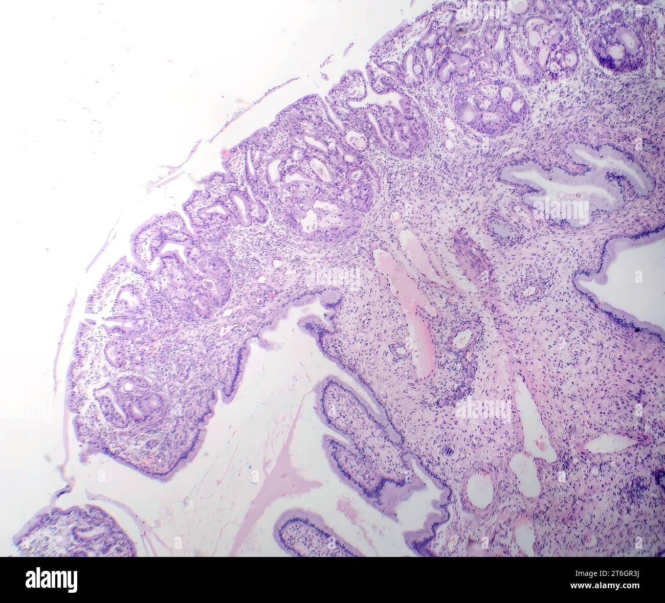 Photomicrograph of nasal polyps, displaying abnormal tissue growth in ...