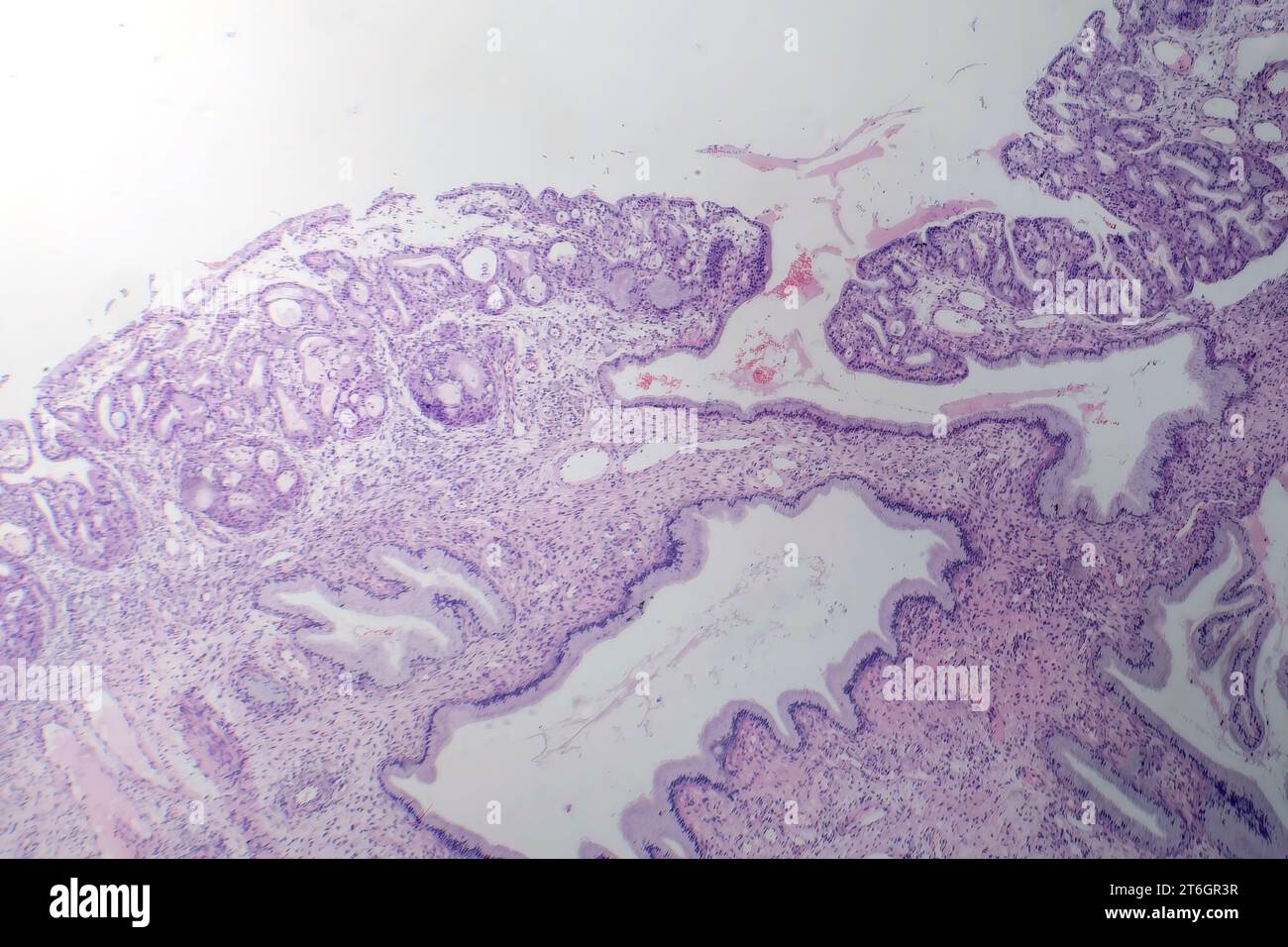 Photomicrograph of nasal polyps, displaying abnormal tissue growth in ...